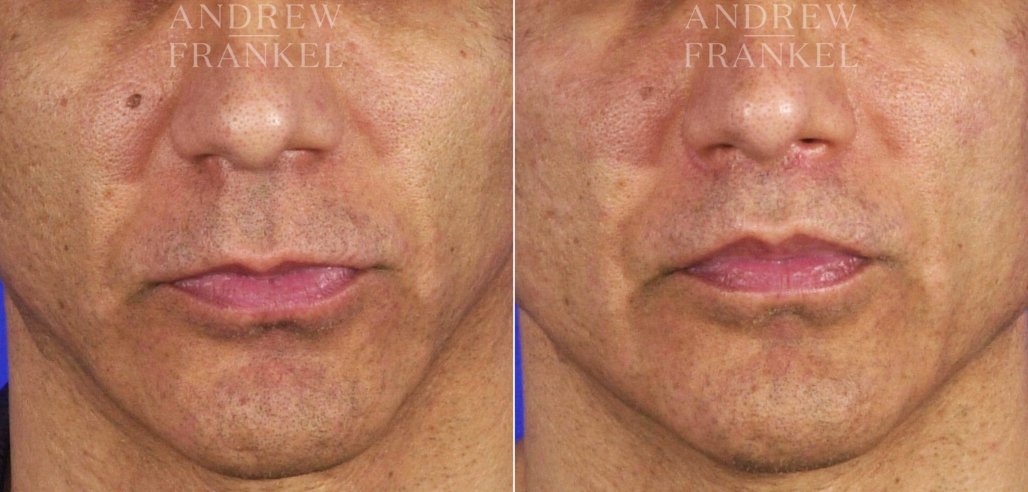 Benefits of Lip Lift: Enhancing Masculine Facial Features