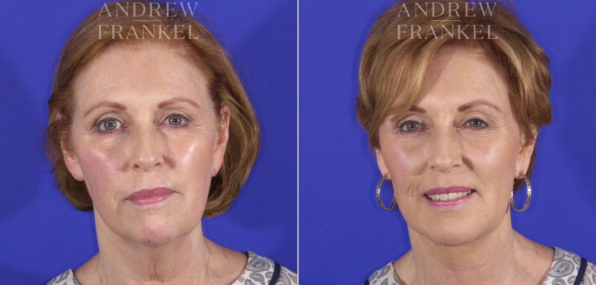 Types of Facelifts: Find the Best Fit for Your Look