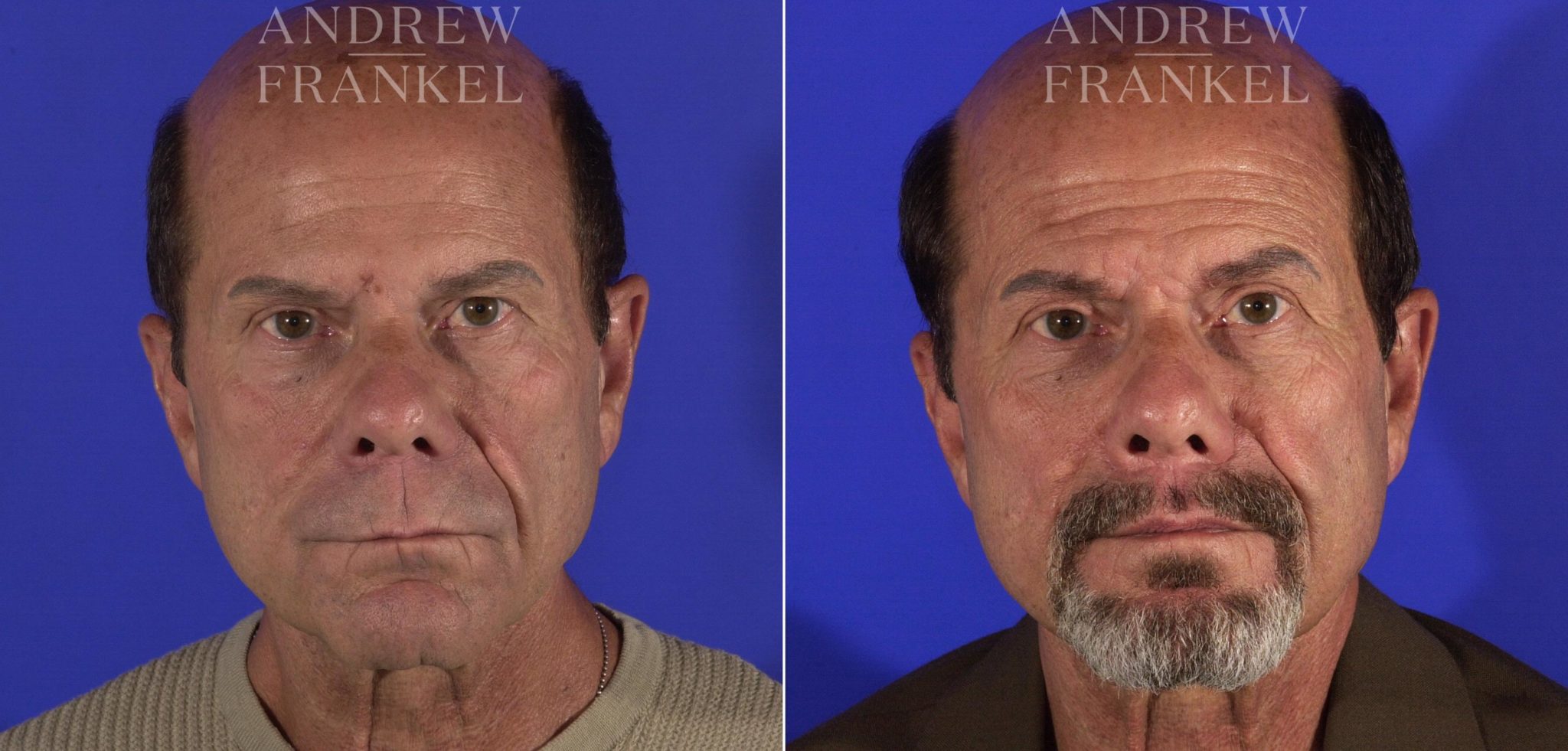 Benefits of Lip Lift: Enhancing Masculine Facial Features