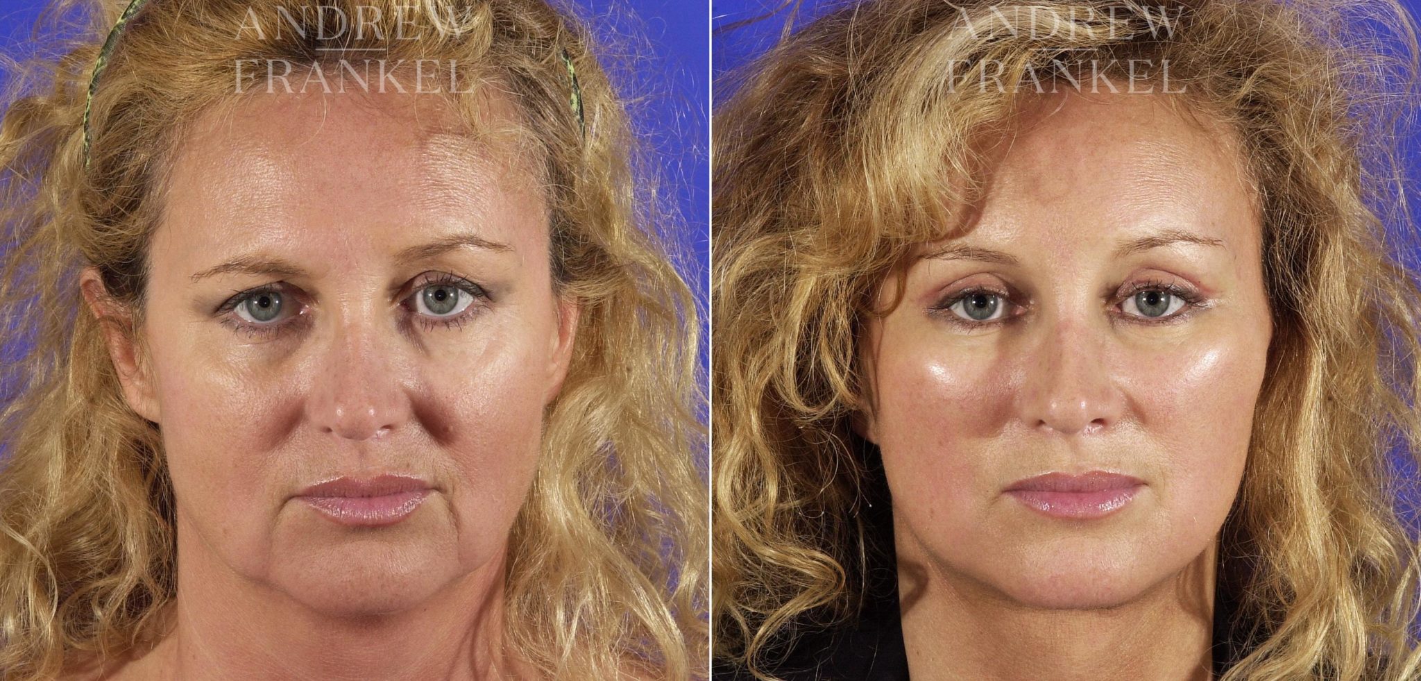 Midface Lift before and after photos - Andrew S. Frankel, MD