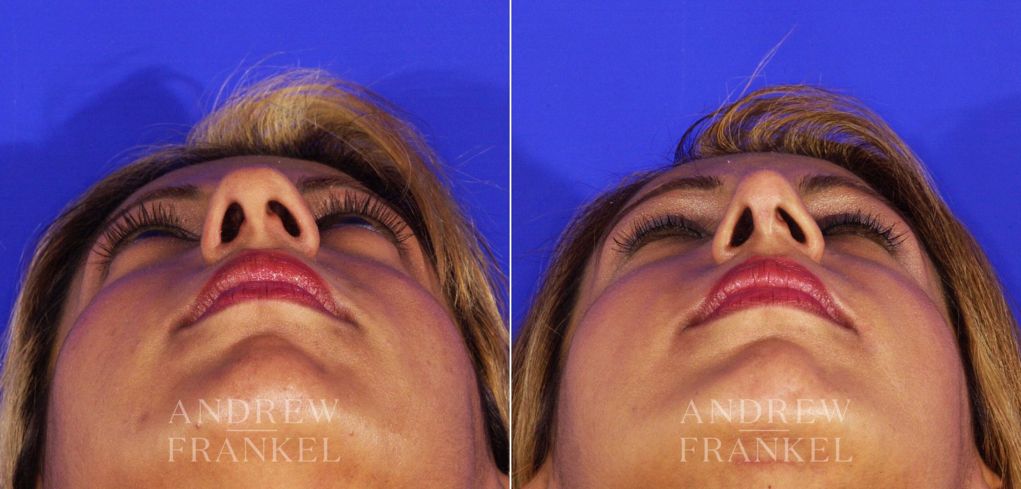 Achieve Balance with Rhinoplasty for Wide Noses