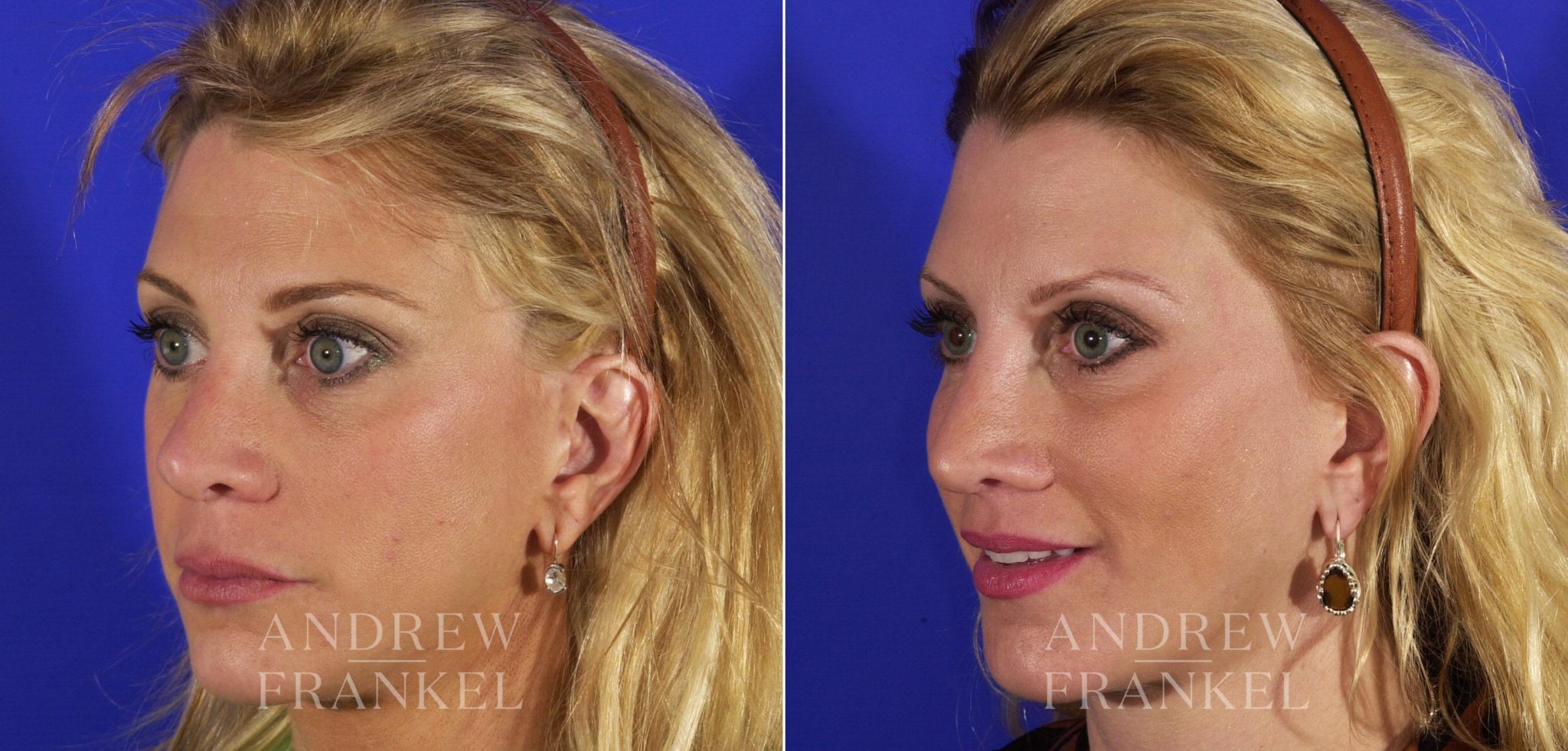 Minimizing Scars for a Brow Lift Surgery | Beverly Hills