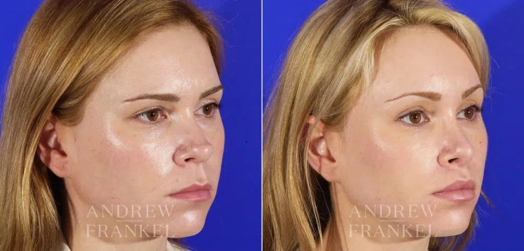 PDO Thread Lift vs. Endoscopic Brow Lift: Techniques Comparison