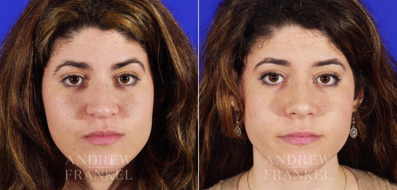 Achieve Balance with Rhinoplasty for Wide Noses