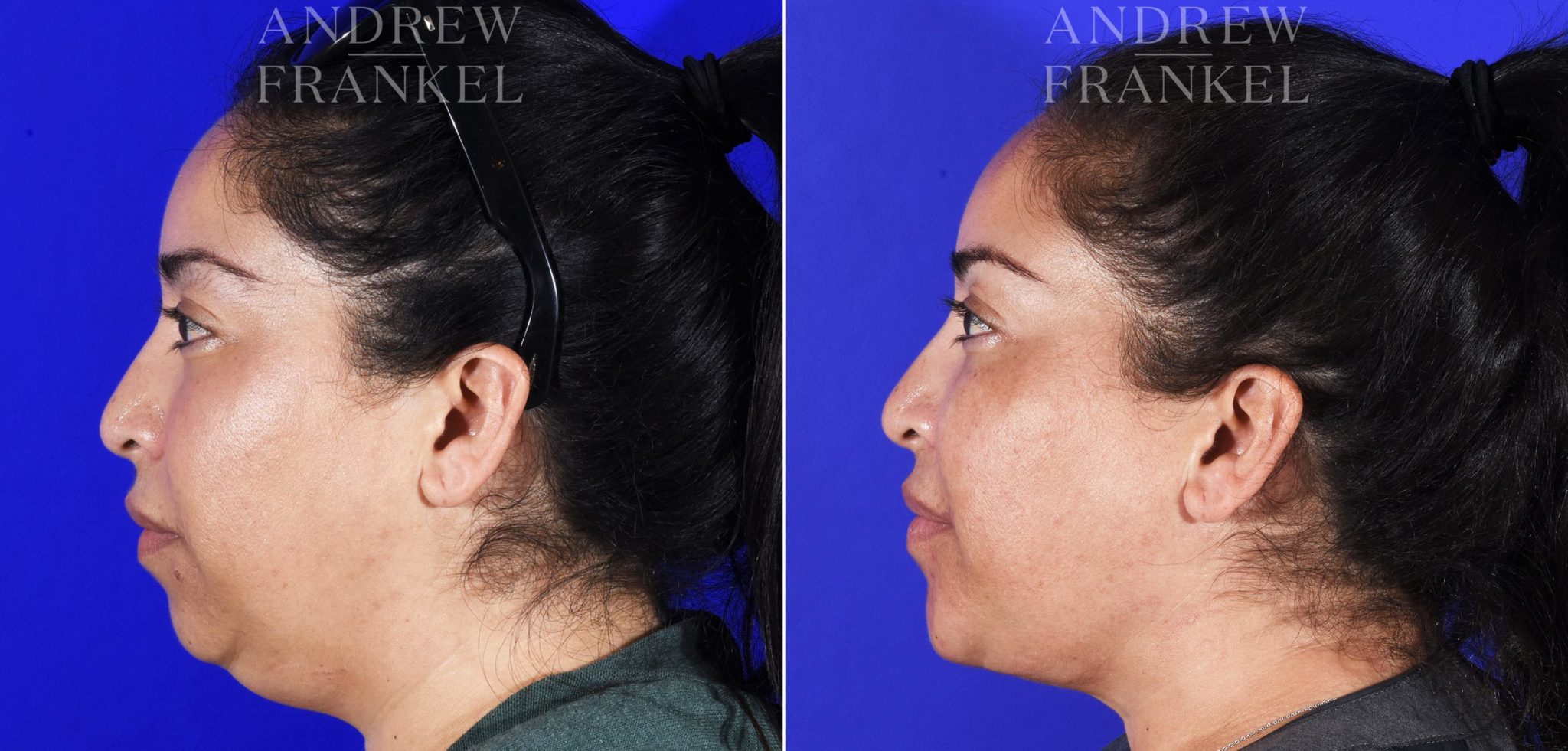 Neck Rejuvenation: Is a Minimally Invasive Lift Suitable for You?
