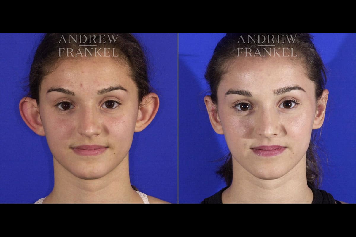 Otoplasty | Beverly Hills, CA