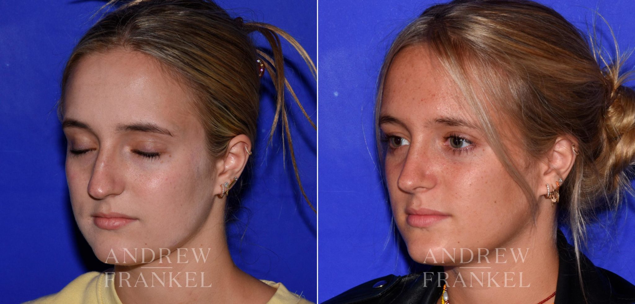 Teenage Nose Jobs: What to Know Before Deciding