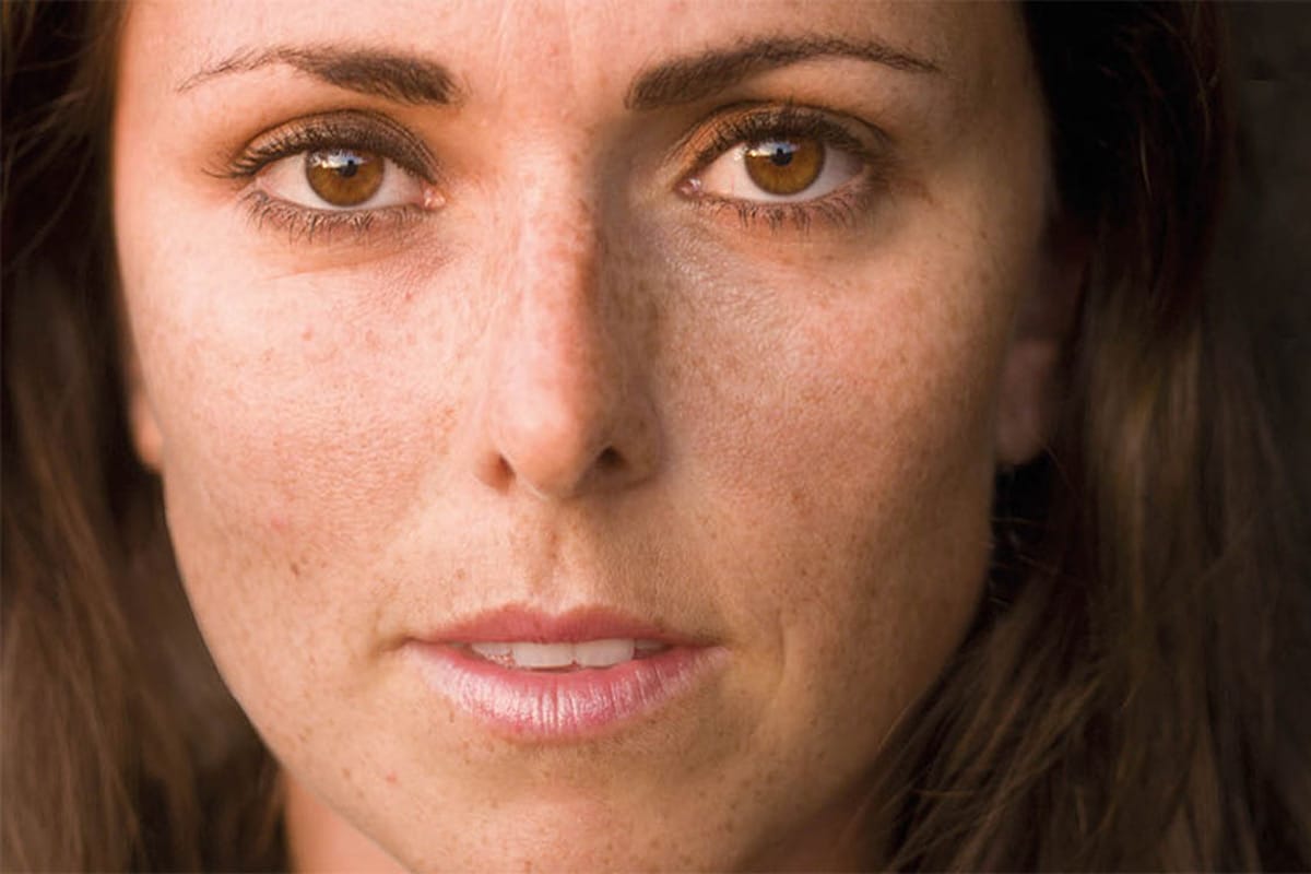 Botox | Facial Wrinkle Reduction | Dr. Frankel | Beverly Hills, CA