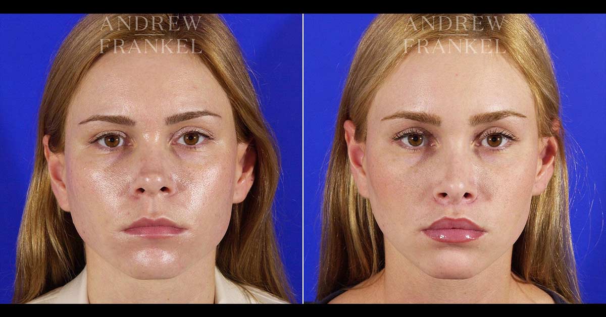 Lip Lift Beverly Hills & Los Angeles, CA | Dr. Andrew Frankel