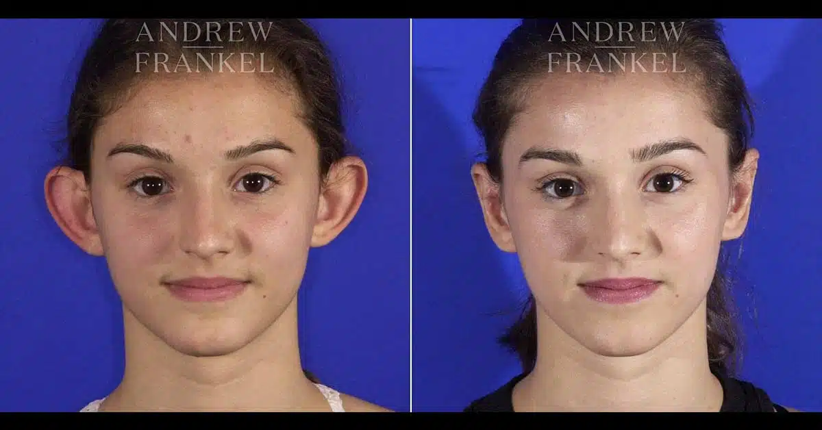 Otoplasty Beverly Hills, CA | Best Ear Surgery in Los Angeles