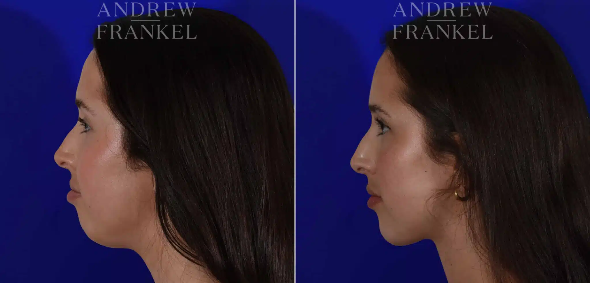 Weak Chin vs Strong Chin: Create a Balanced Jawline