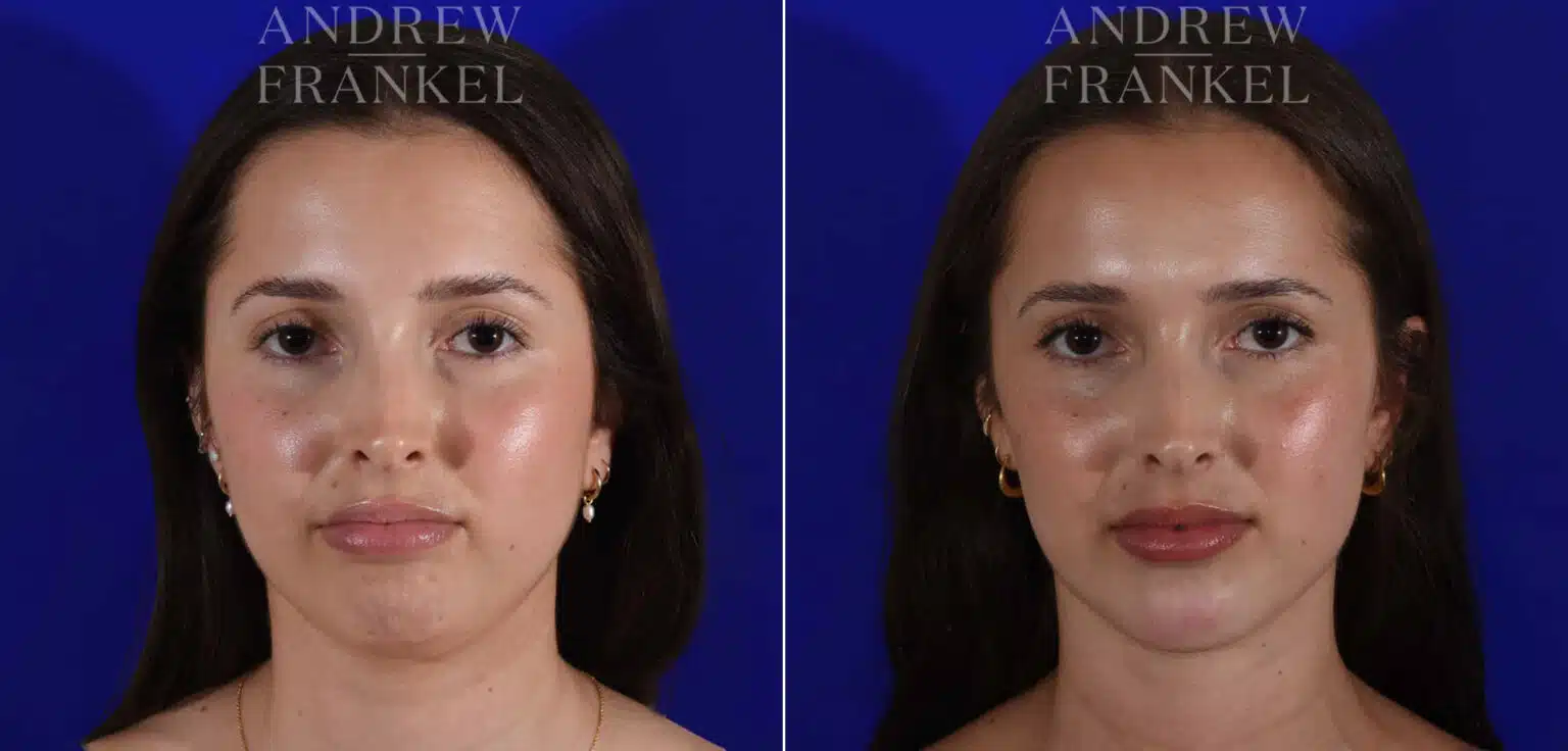Weak Chin vs Strong Chin: Create a Balanced Jawline