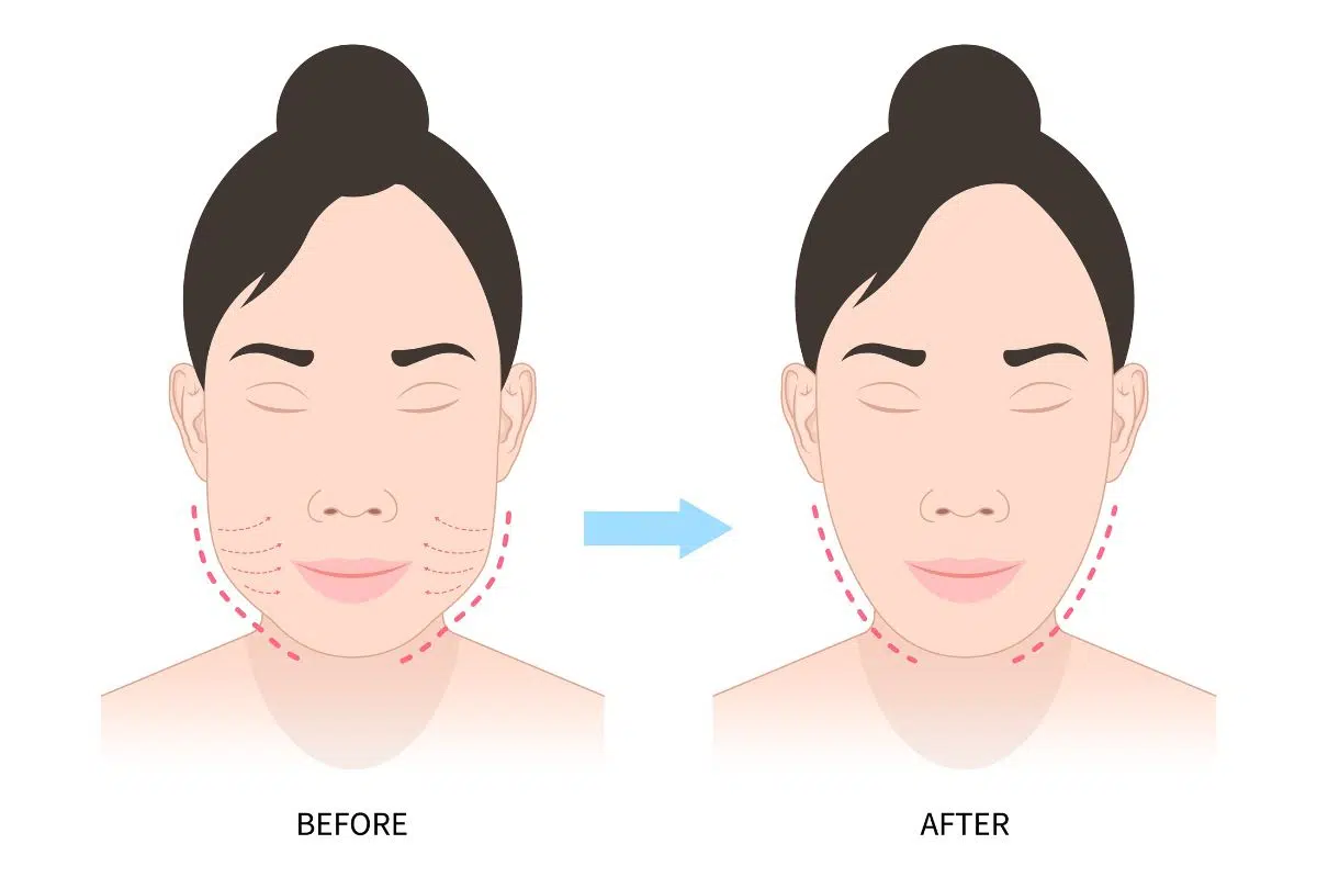 Buccal Fat Removal for Jowls | Dr. Frankel | Beverly Hills