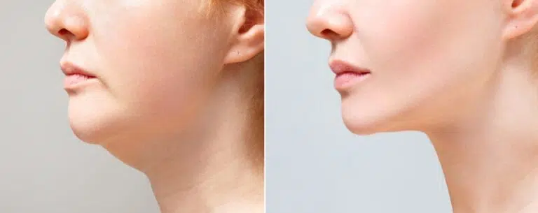 Weak Chin vs Strong Chin: Create a Balanced Jawline